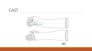 Fixation Methods and Implants for Distal Radius Fractures & Post-Op ...