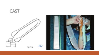 Fixation Methods and Implants for Distal Radius Fractures & Post-Op ...