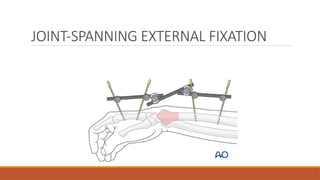 Fixation Methods and Implants for Distal Radius Fractures & Post-Op ...