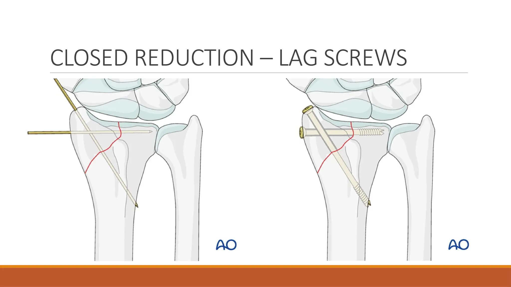 Fixation Methods and Implants for Distal Radius Fractures & Post-Op ...