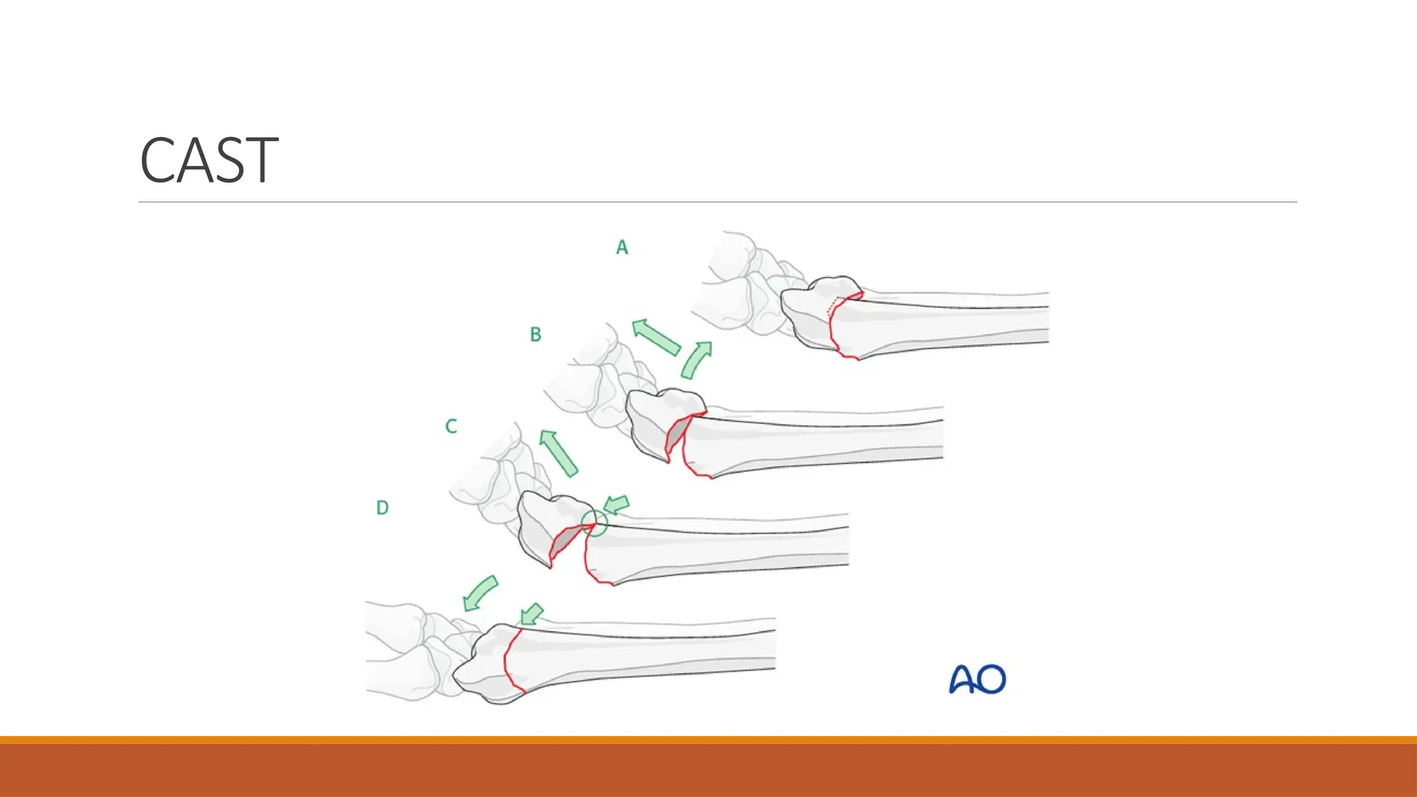 Fixation Methods and Implants for Distal Radius Fractures & Post-Op ...