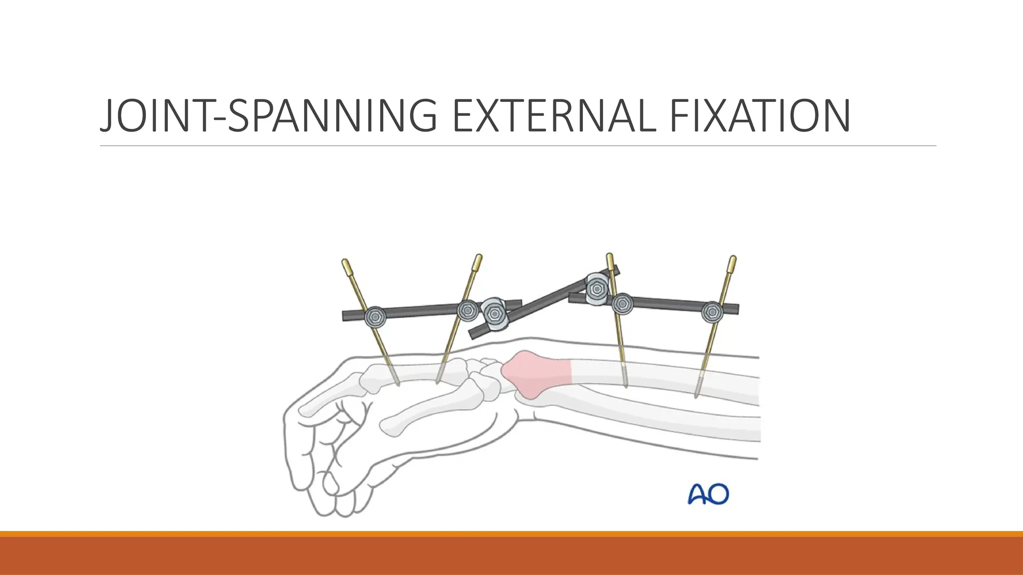 Fixation Methods and Implants for Distal Radius Fractures & Post-Op ...