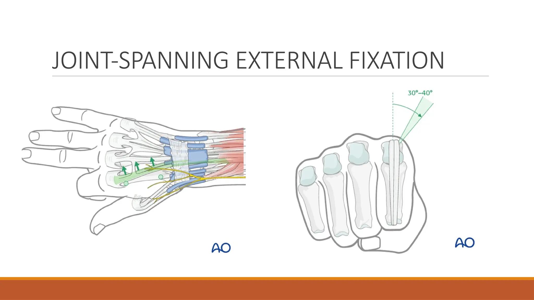 Fixation Methods and Implants for Distal Radius Fractures & Post-Op ...
