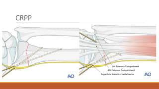 Fixation Methods and Implants for Distal Radius Fractures & Post-Op ...