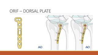 Fixation Methods and Implants for Distal Radius Fractures & Post-Op ...