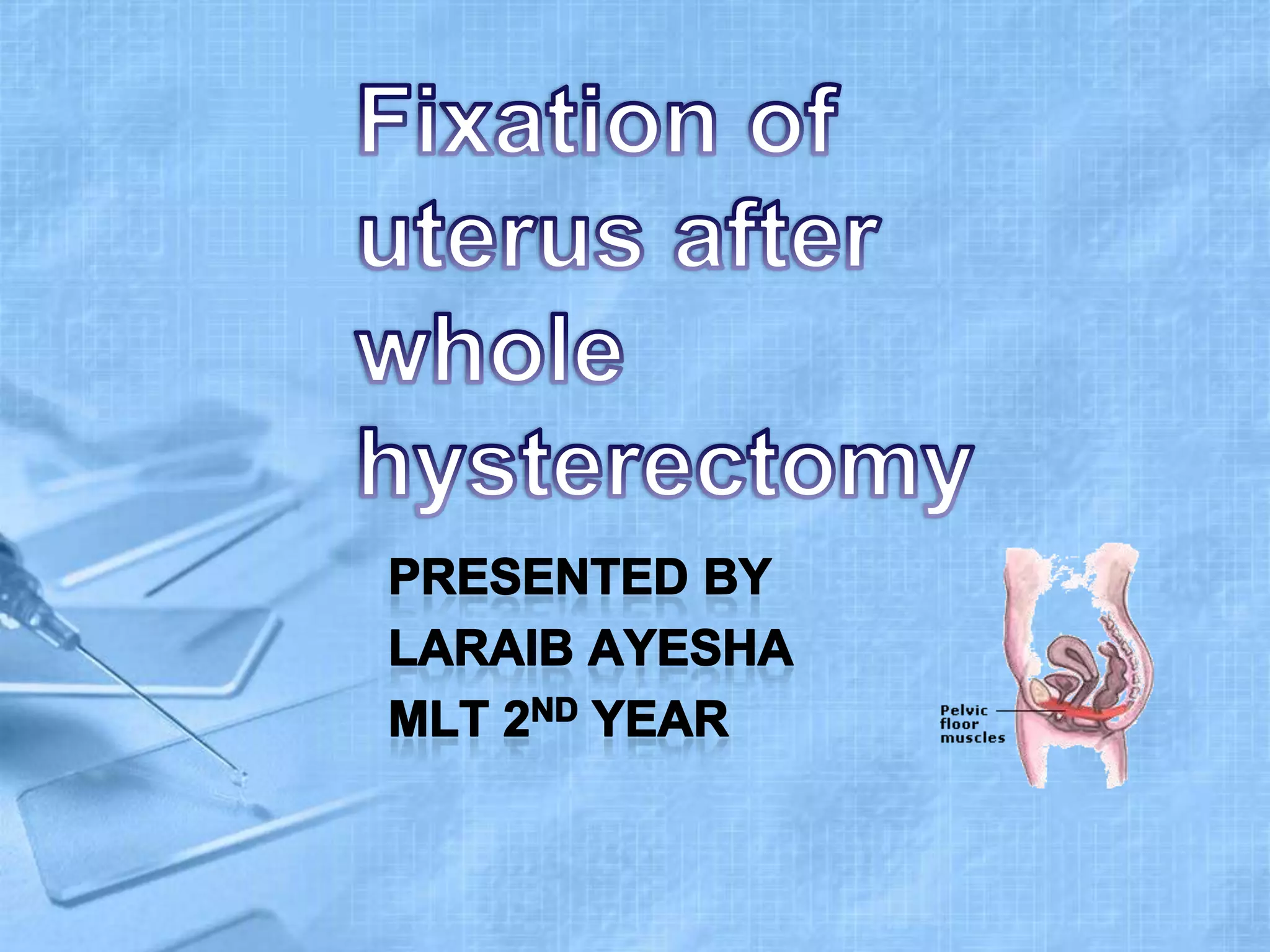 Fixation of uterus after whole hysterectomy | PPTX