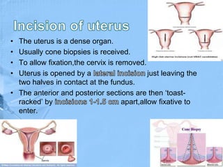 Fixation of uterus after whole hysterectomy | PPTX