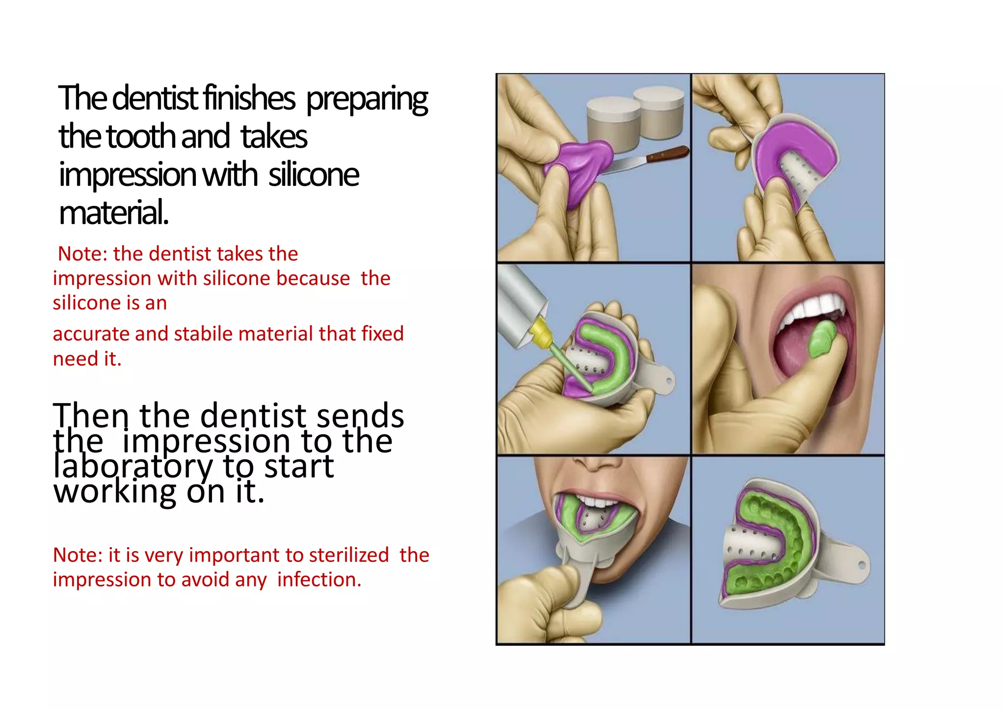 cast and die preparation in fixed prosthodontics | PDF