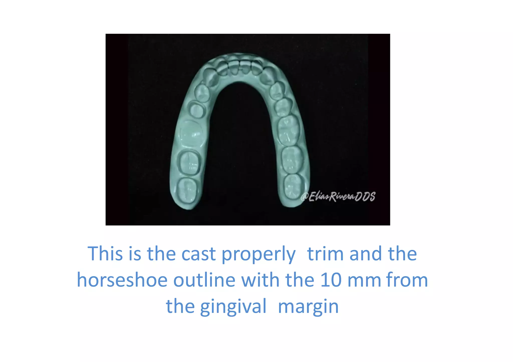 cast and die preparation in fixed prosthodontics | PDF