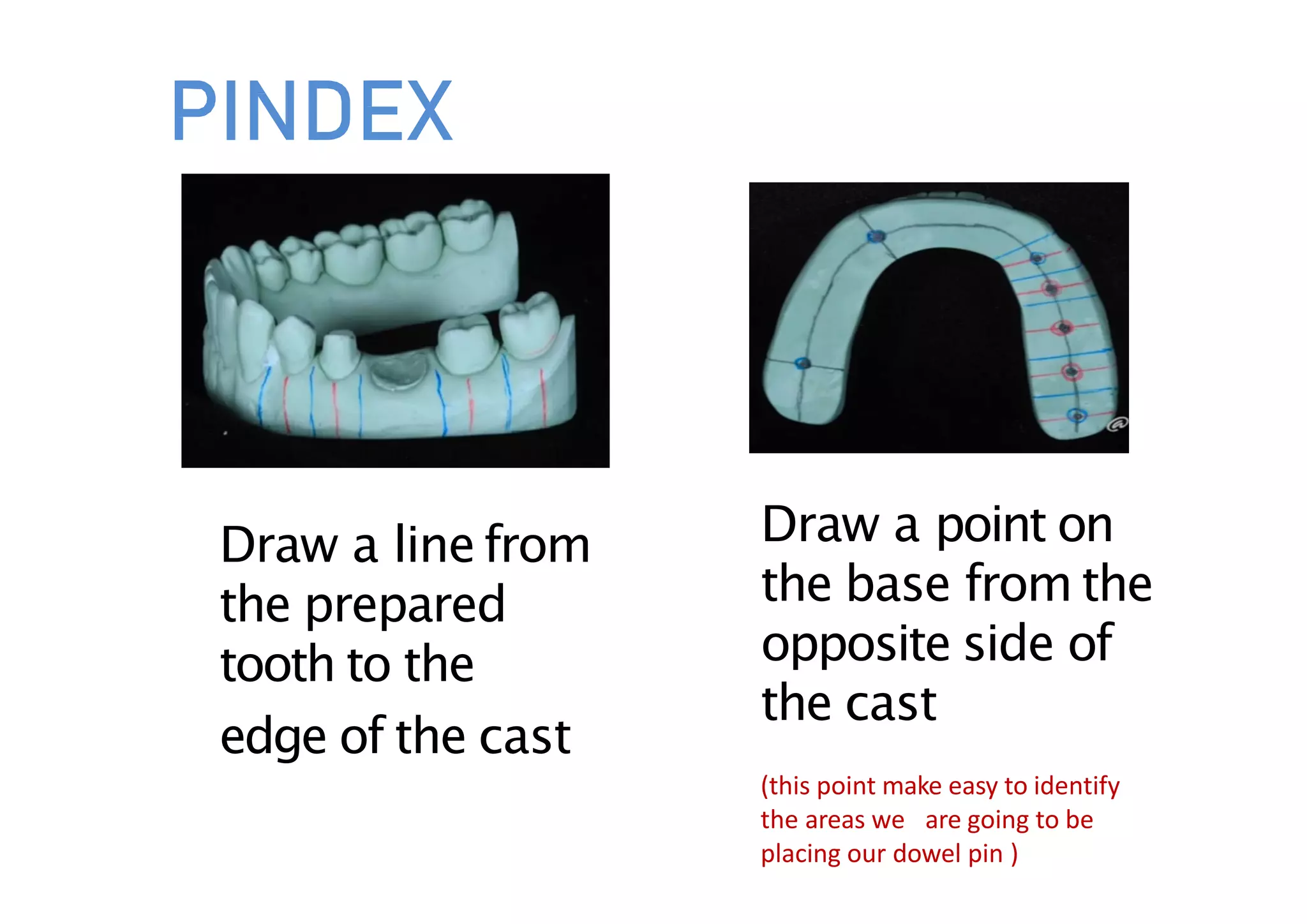 cast and die preparation in fixed prosthodontics | PDF