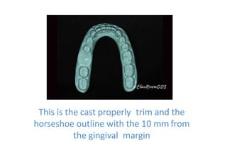 cast and die preparation in fixed prosthodontics | PDF