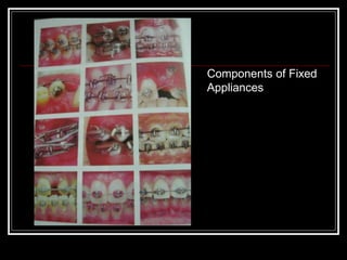 Fixed Appliance O.ppt