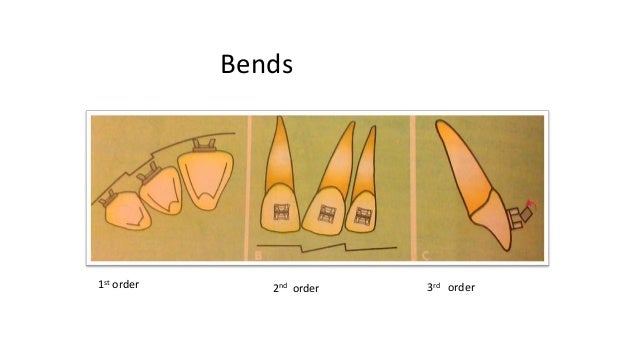 Fixed appliances in orthodontics