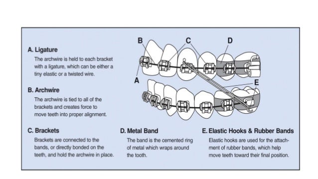 Fixed appliances in orthodontics