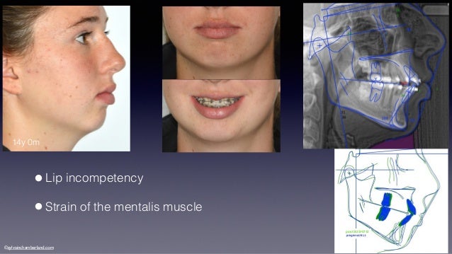 Fixed applicance management of class II correction