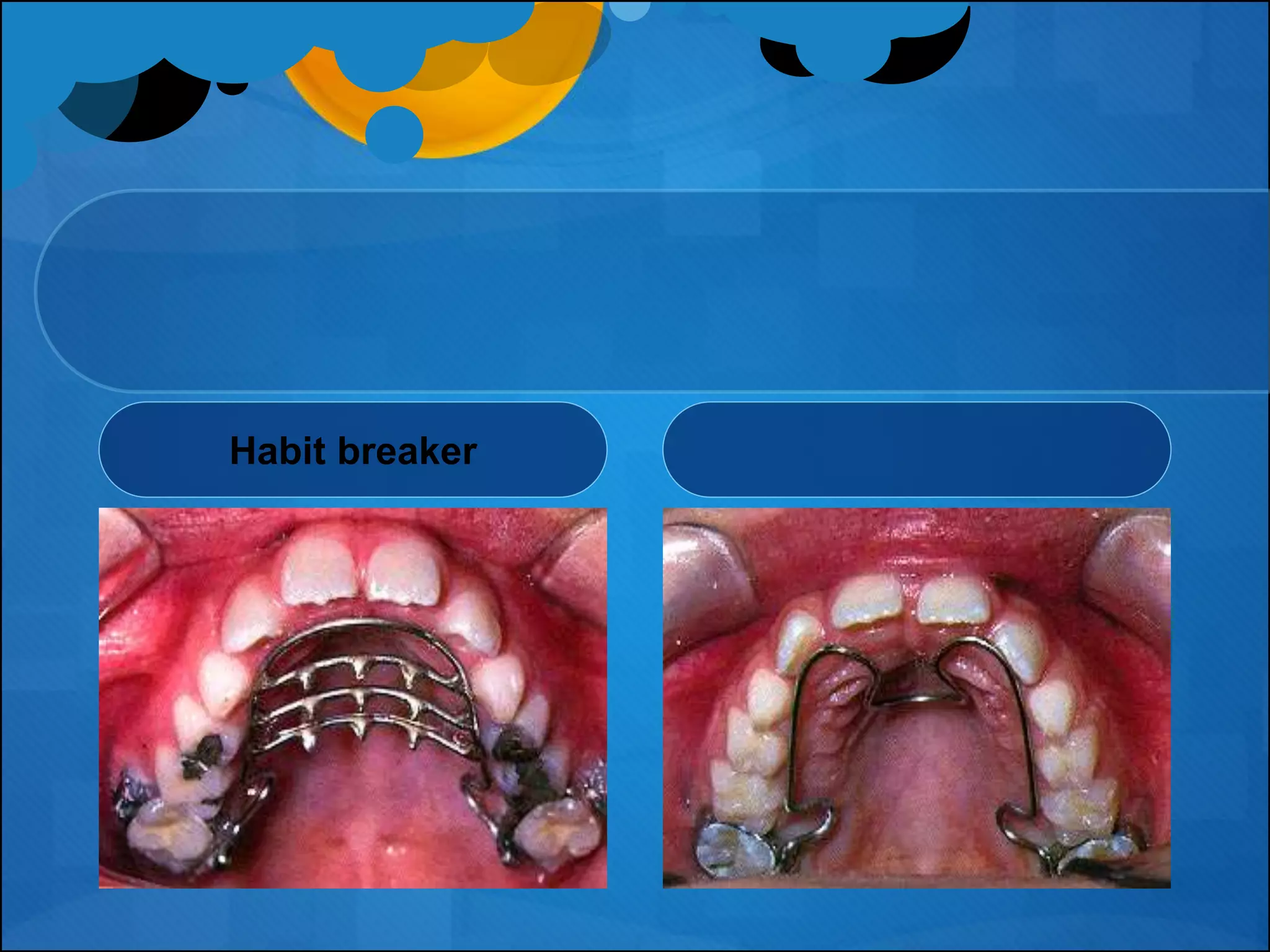 Fixed orthodontic appliances | PPTX