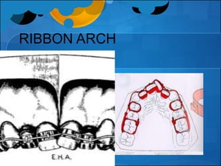 Fixed orthodontic appliances | PPTX