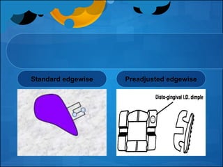 Fixed orthodontic appliances | PPTX