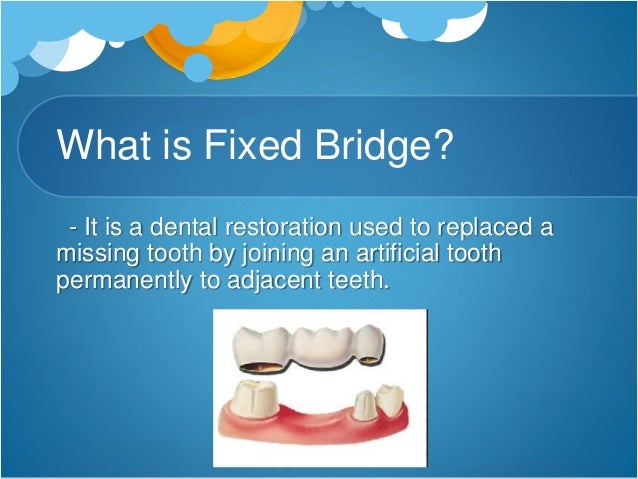 Fixed bridge slideshare