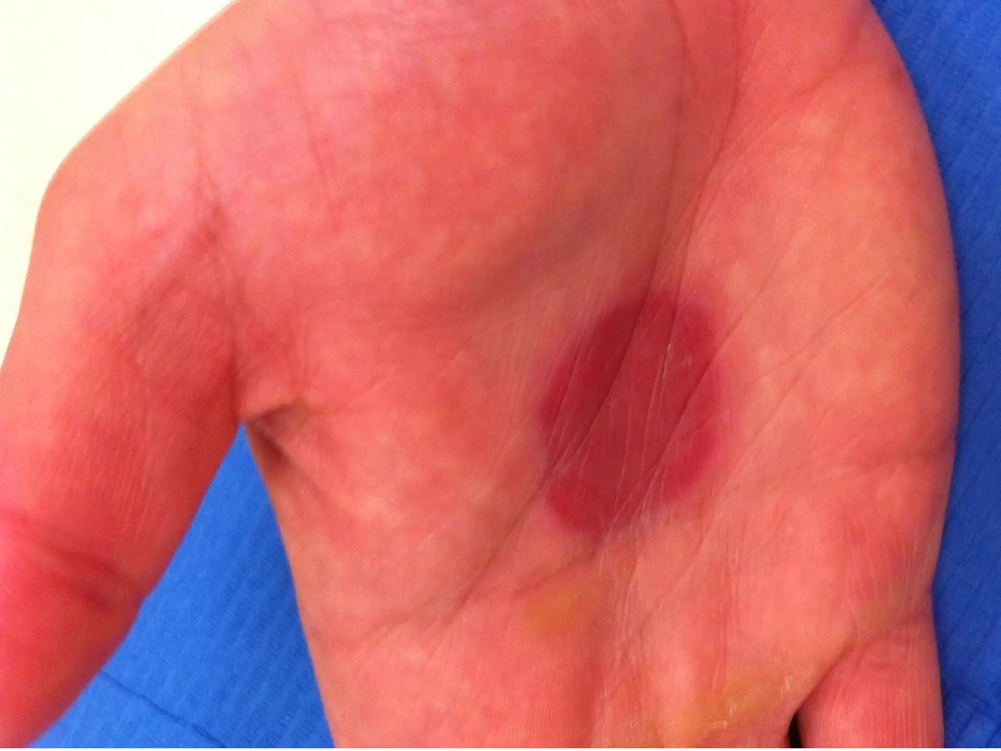 Fixed drug eruption | PPT