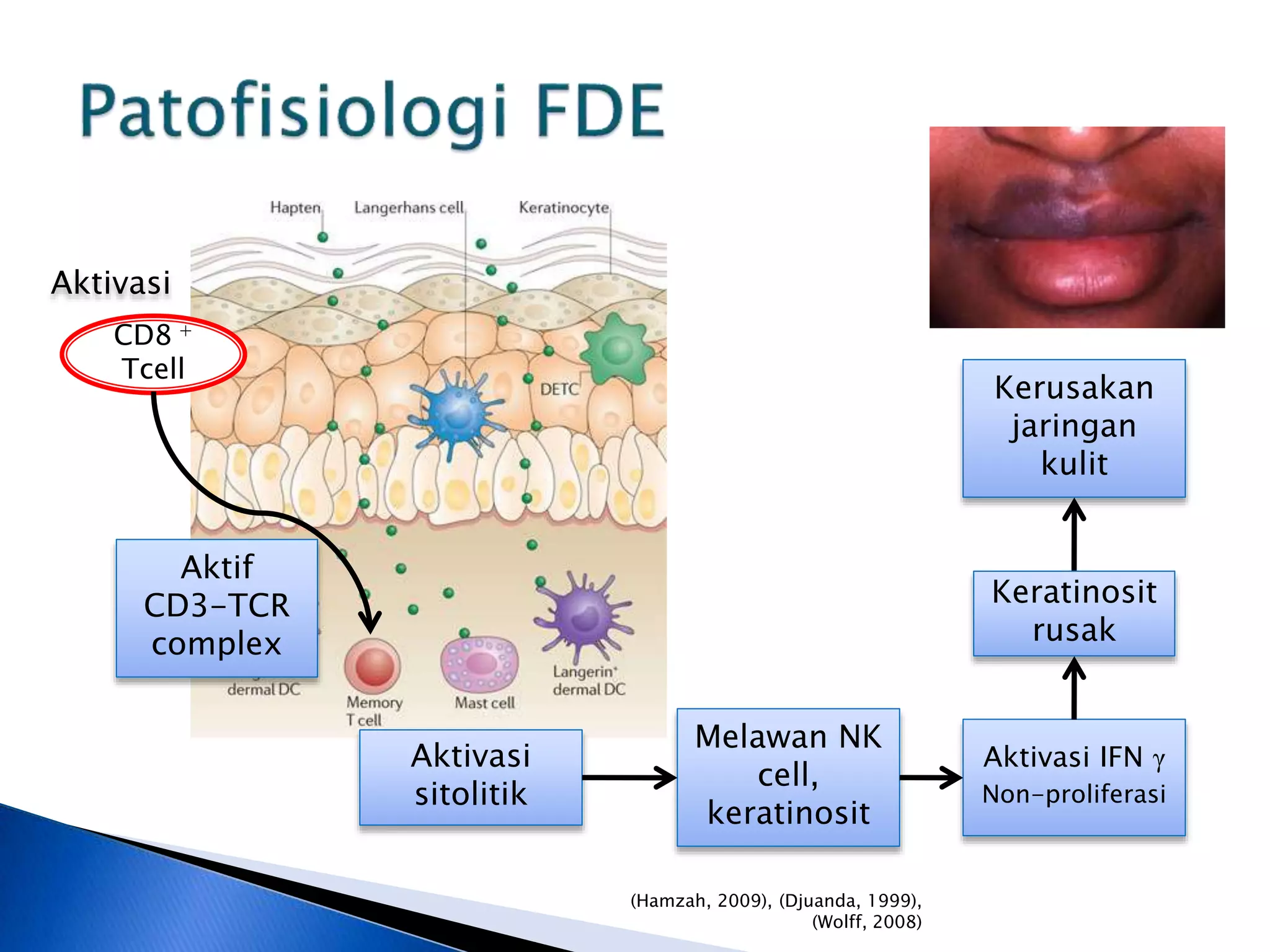 Fixed drug eruption x hipersensitivitas | PPTX