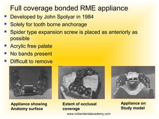 Fixed expansion orthodontic appliances / /certified fixed orthodontic ...