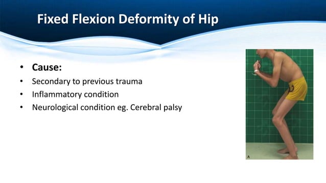 Fixed Flexion Deformity