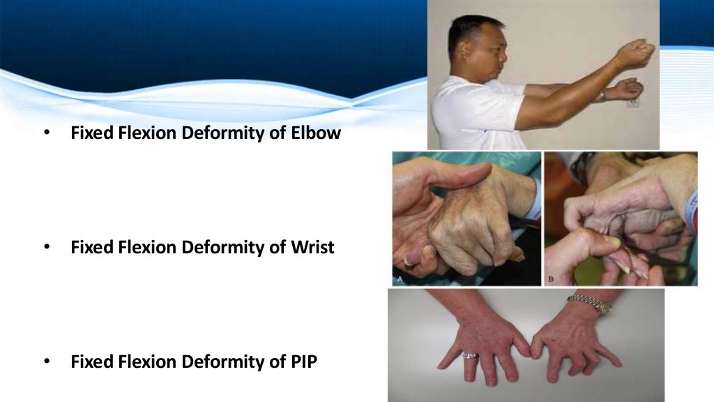 Fixed Flexion Deformity