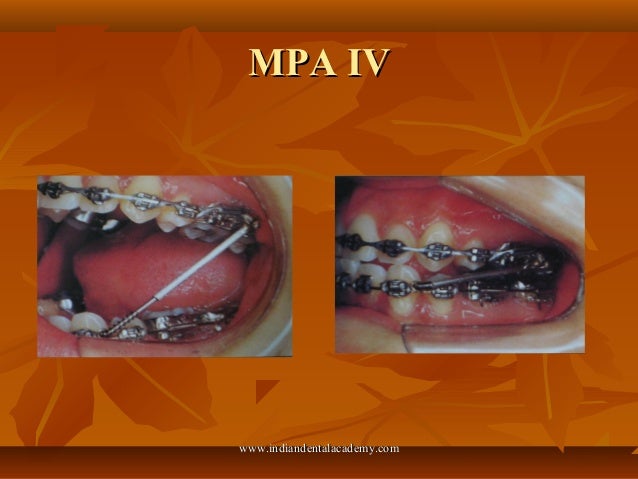 Fixed functional appliance