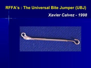 Fixed functional appliances | PPT