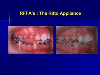 Fixed functional appliances | PPT