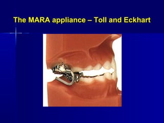 Fixed functional appliances | PPT