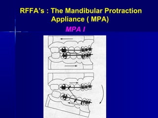 Fixed functional appliances | PPT