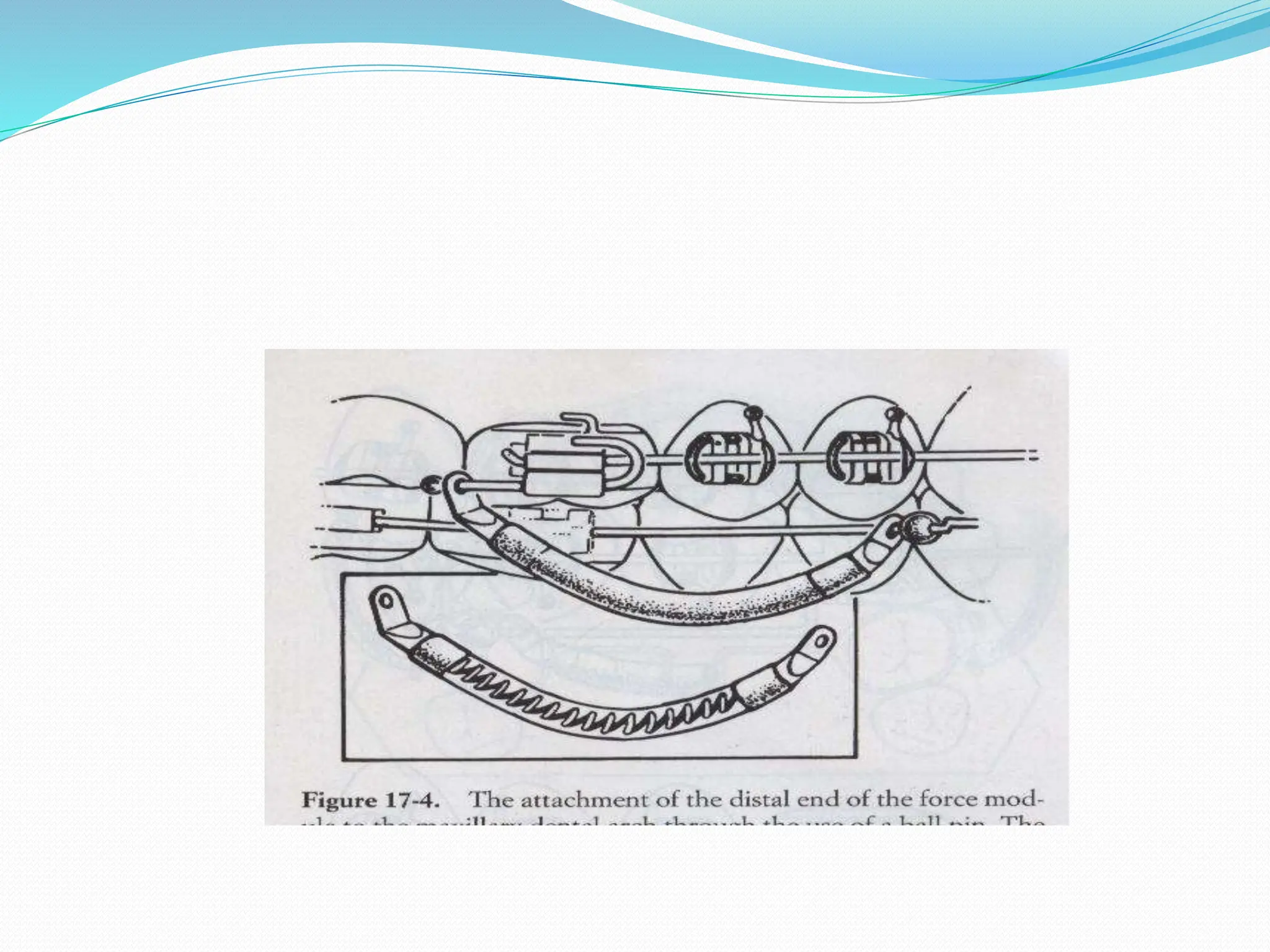 Fixed functional appliances in Orthodontics | PPTX