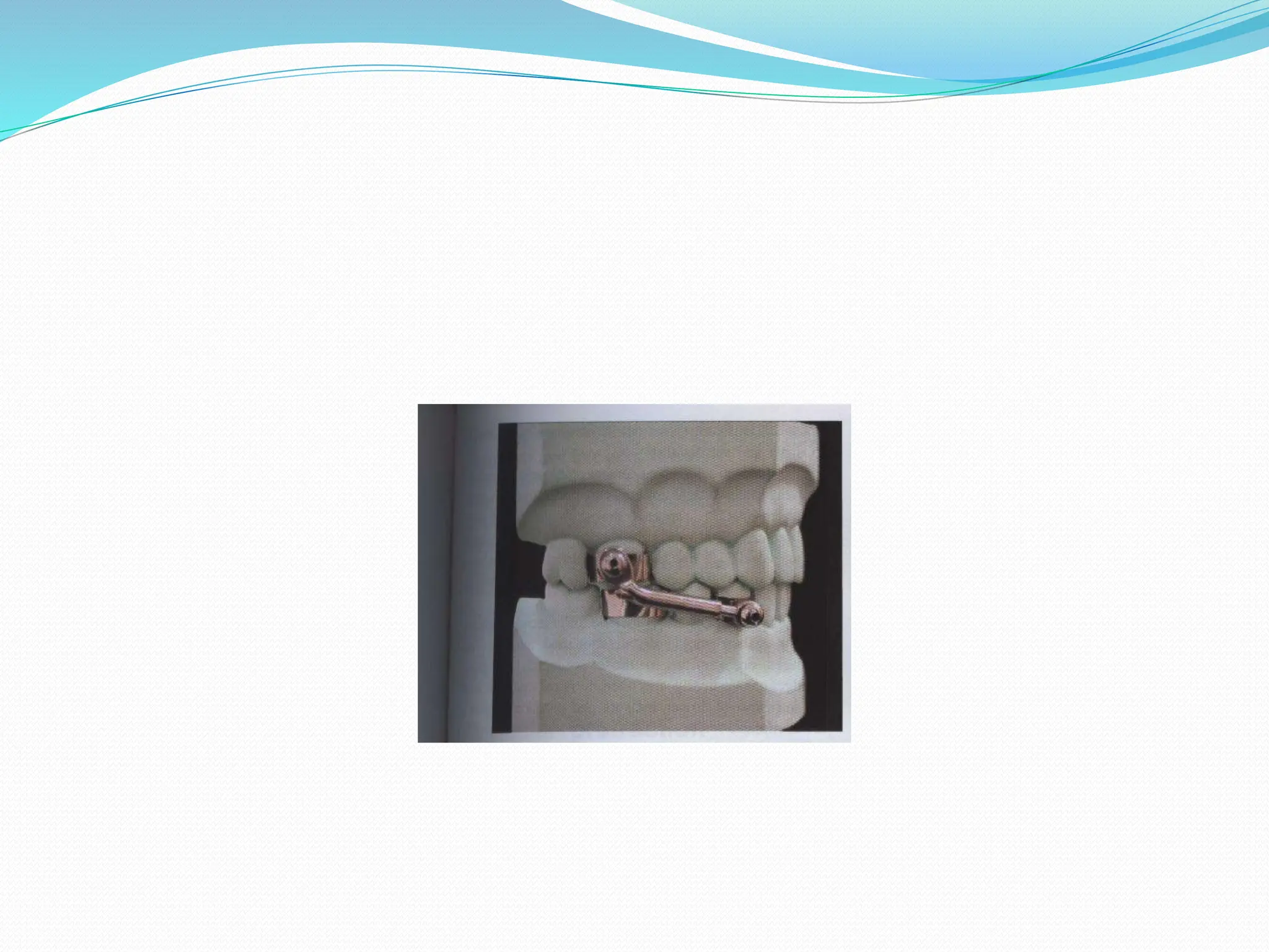 Fixed functional appliances in Orthodontics | PPTX