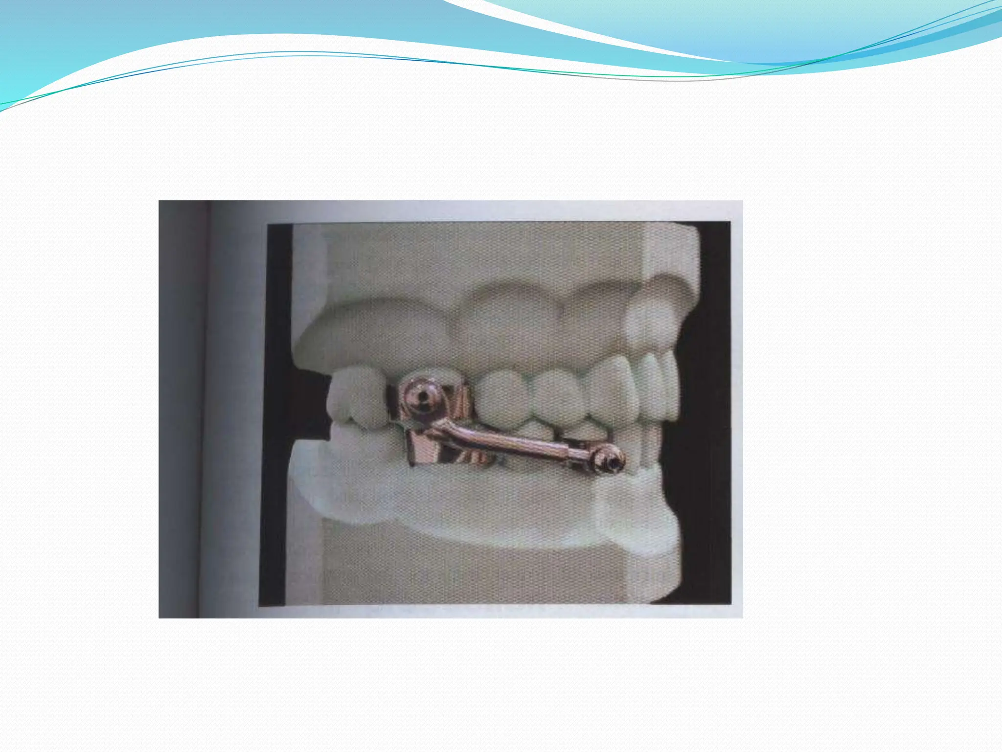 Fixed functional appliances in Orthodontics | PPTX