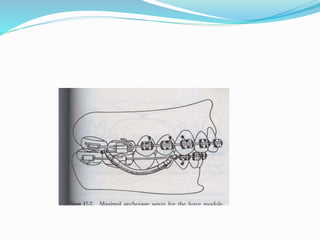 Fixed functional appliances in Orthodontics | PPTX