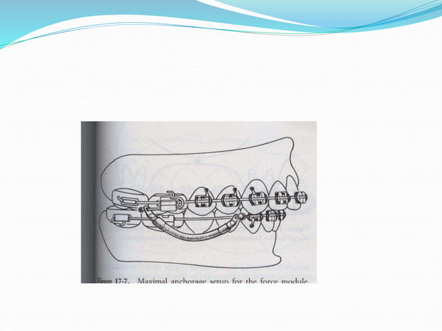 Fixed functional appliances in Orthodontics | PPTX | Dental Health ...