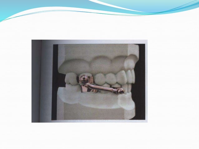 Fixed functional appliances in Orthodontics | PPTX | Dental Health ...
