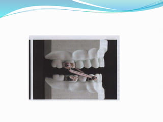 Fixed functional appliances in Orthodontics | PPTX