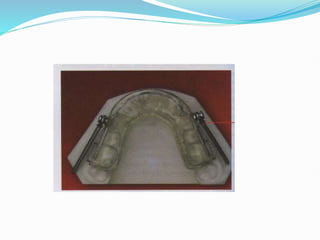 Fixed functional appliances in Orthodontics | PPTX