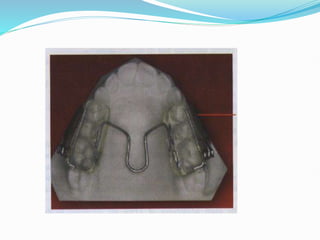 Fixed functional appliances in Orthodontics | PPTX