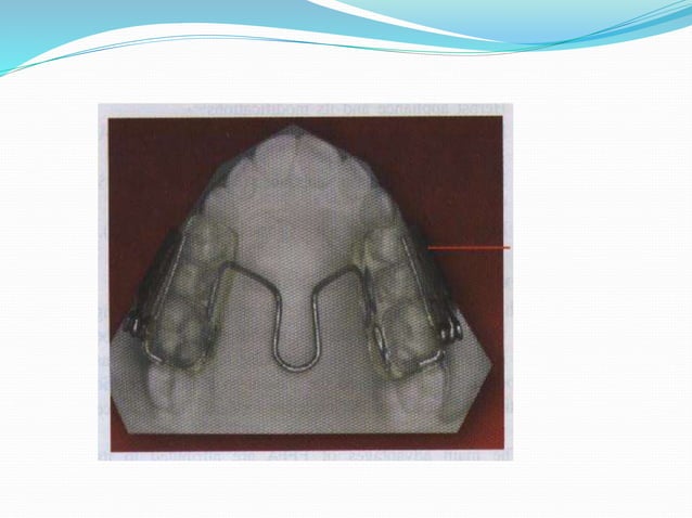 Fixed functional appliances in Orthodontics | PPTX | Dental Health ...