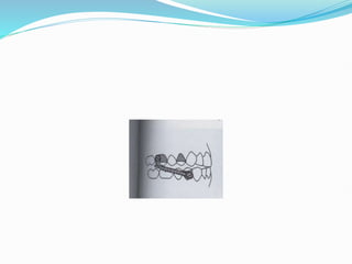 Fixed functional appliances in Orthodontics | PPTX