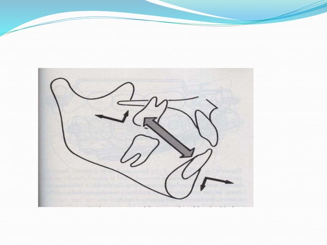 Fixed functional appliances in Orthodontics | PPTX | Dental Health ...