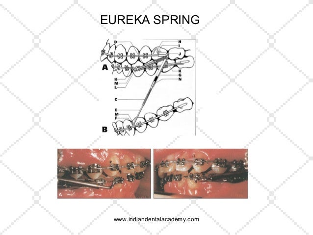 Fixed functional appliances