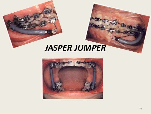 Fixed functional appliances dds