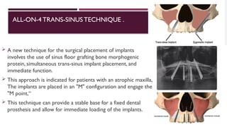 Fixed implant treatment options in edentulous patients.pptx