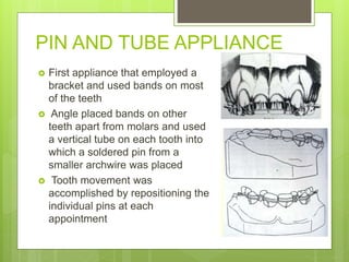 Fixed Orthodontics | PPT