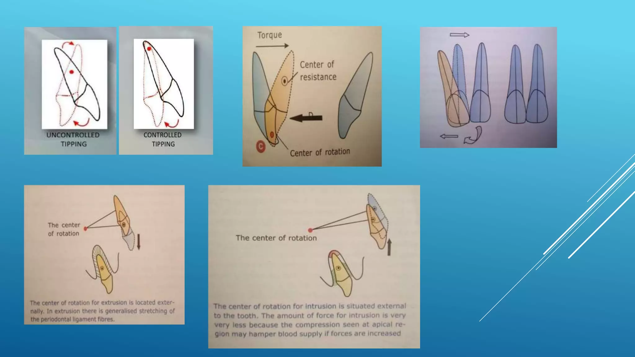 Fixed orthodontic appliances | PPTX